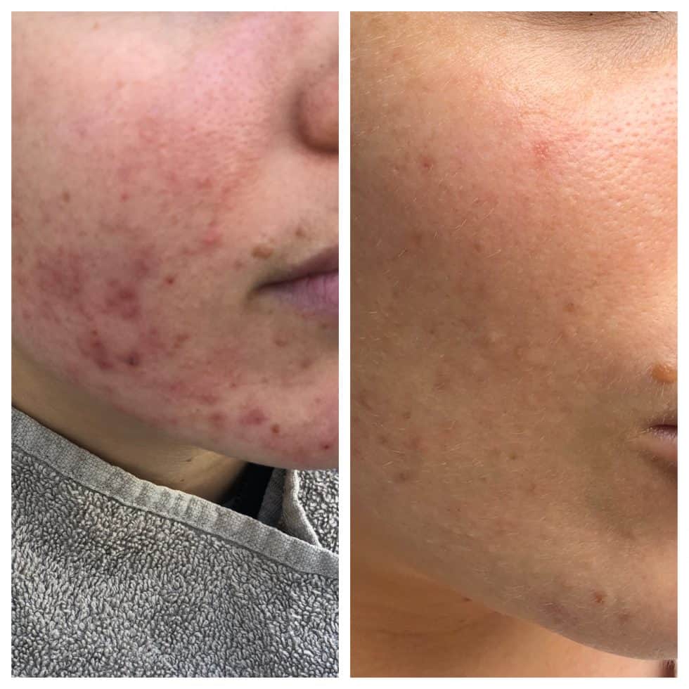 Tips om van je littekens af te komen | VIVE Huidtherapie B.V