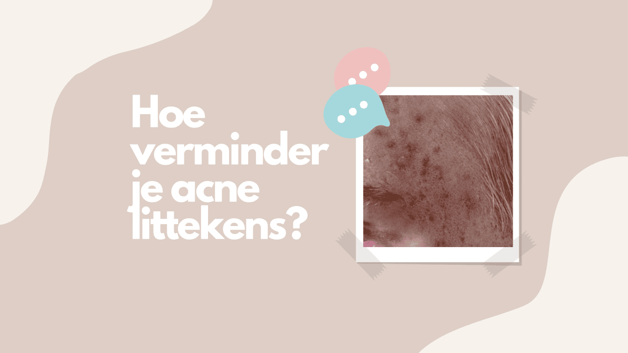 Acne littekens | VIVE Huidtherapie B.V